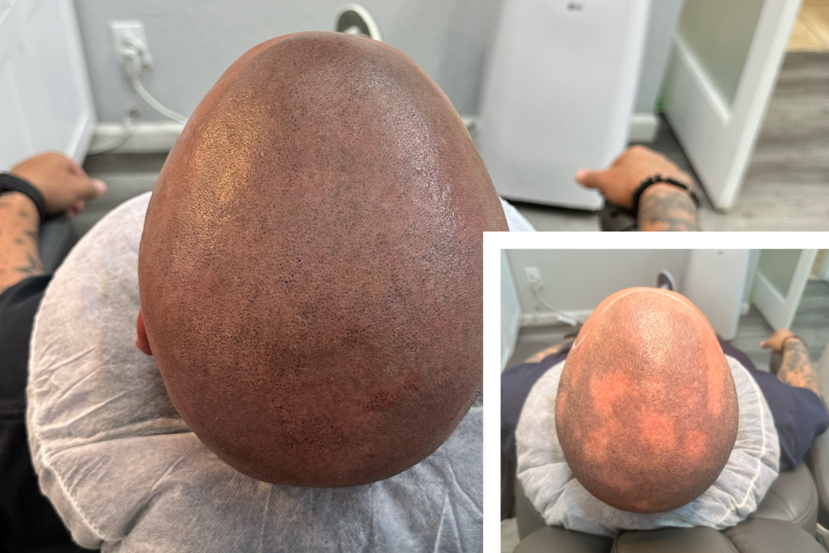 Daniel Arias and NuHair Ink Revolutionize Scalp Micro Pigmentation